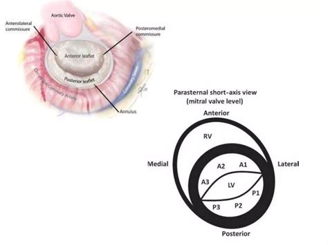 Echo Mitral Stenosis PPTX Heart And Cardiovascular Diseases Diseases And Conditions