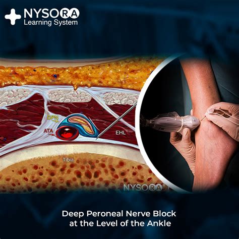 Superficial Peroneal Nerve Block