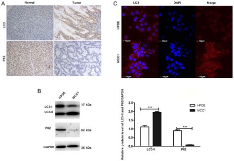 Autophagy Is Hyperactivated In Pancreatic Mucinous Cystadenocarcinoma Download Scientific