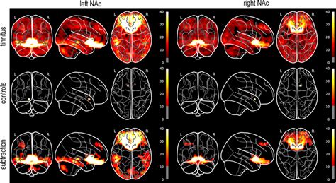 Glassbrain Visualizations Of Voxelwise RsFC With Left Right NAc Seed