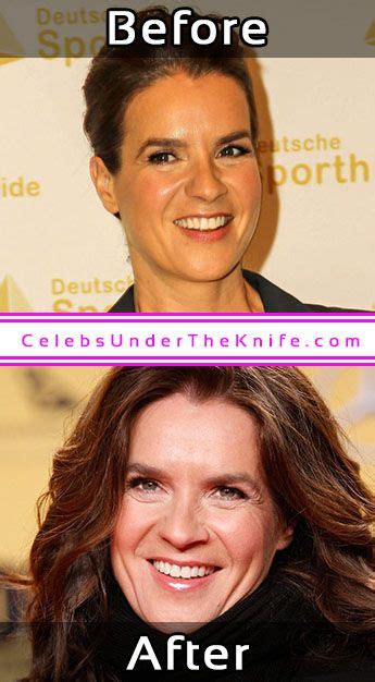 Katarina Witt Photos Cosmetic Surgery Celebsundertheknife Celebs Celebrity Plasticsurgery