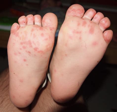Hand Foot And Mouth Disease Pediatrics Medbullets Step 2 3