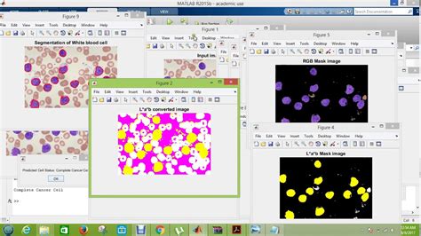 Matlab Code For Leukemia Cancer Cell Detection Youtube