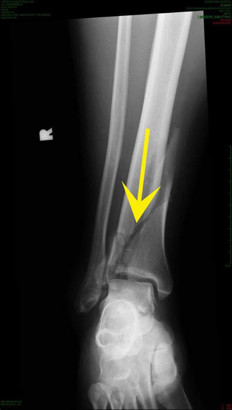 X Ray Leg