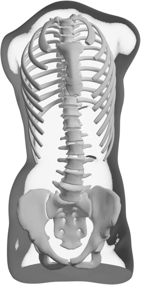 Computer Generated 3d Model Showing The Whole Patients Trunk Geometry