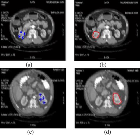 Figure 3 From Segmentation Of Abdominal Organs On Ct Images Using