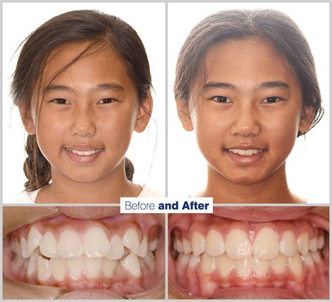 Orthodontist Braces Before And After