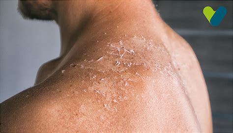 Actinic Keratosis Vs Basal Cell Carcinoma Pictures 57 Off