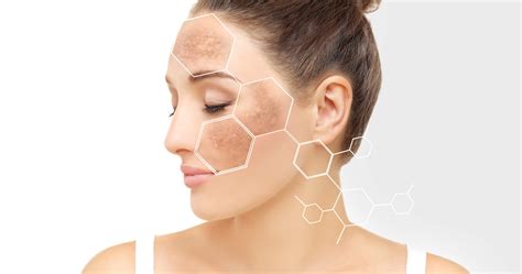 Sun Damage Reverse Laser Treatment For Sunspots Gcfp