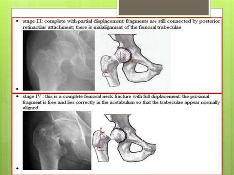 Nof Fracture Pptx