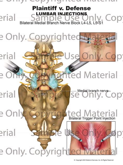Bilateral Nerve Block Trigger Point MotionLit