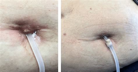 A Exit Site Infection With Erythema And Suppurative Lesion At Download Scientific Diagram