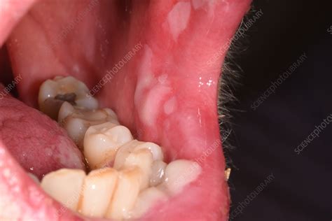 Ulcer In A Womans Mouth Stock Image C058 5459 Science Photo Library