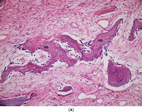 Figure 8 From Evaluation Of The Efficacy Of Mineralized Dentin Graft In The Treatment Of