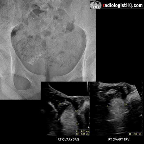 Right Ovarian Dermoid Cyst With Teeth On X Ray Rradiology