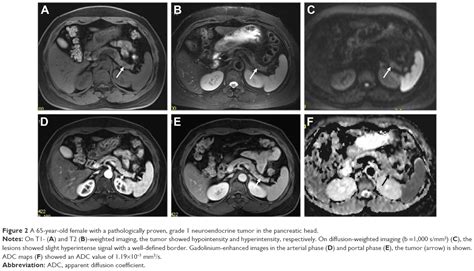 Pancreatic Neuroendocrine Neoplasms At Magnetic Resonance Imaging Ott
