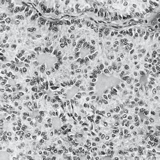 Sex Cord Tumor With Annular Tubules The Tumor Is Composed Of Download Scientific Diagram
