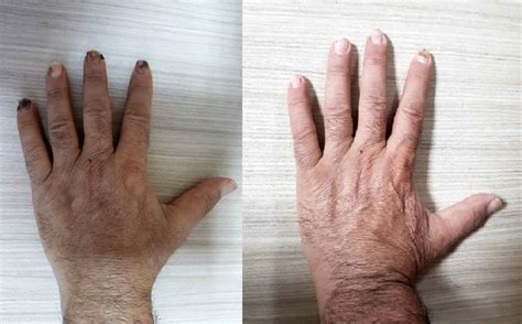 A Left Hand Ischemia After Tevar Procedure B Healed After Carotid Download Scientific