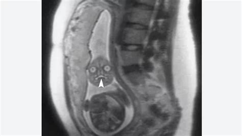 Photo Gallery What Does Fetal Medical Imaging Look Like