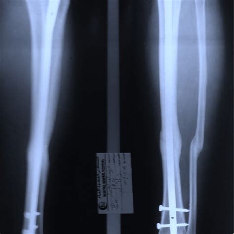A Open Fracture Of The Tibia Type Iiib Download Scientific Diagram