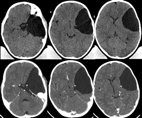 Cirugía De Los Quistes Aracnoideos Neurocirugia