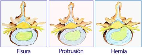 Causas De Hernia Discal Lumbar Entre La L4 Y L5 Fisioonline