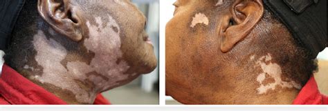 Right And Left Sided Asymmetric Hypopigmented Patches Of The Head And