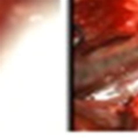 Demonstration Of Surgical Stages Of The Lumbar Spinous Download Scientific Diagram