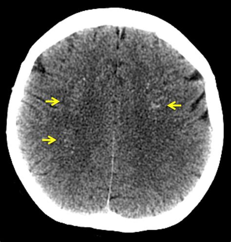 Pseudohypoparathyroidism Causing Multiple Brain Calcifications Pmc