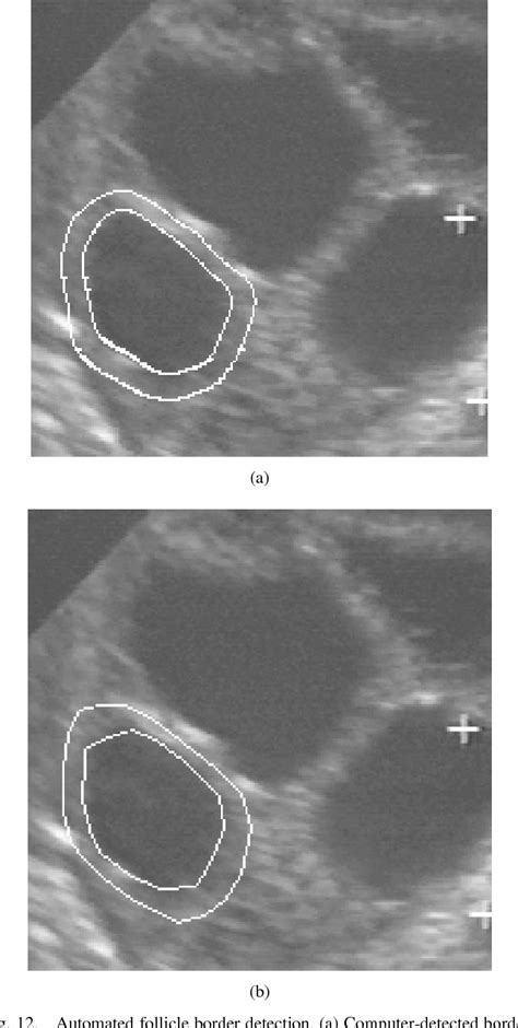 Figure 9 From Ovarian Ultrasound Image Analysis Follicle Segmentation Semantic Scholar