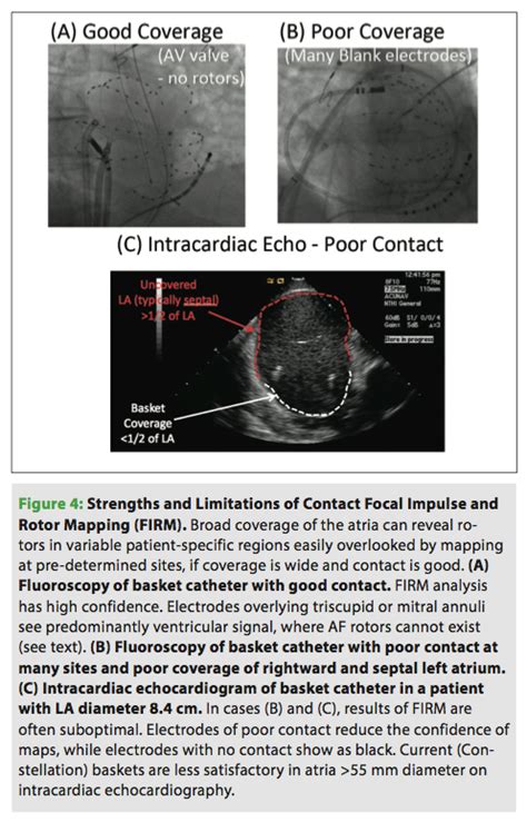 What Is An Atrial Fibrillation Rotor In Patients Rationale For Focal Impulse And Rotor