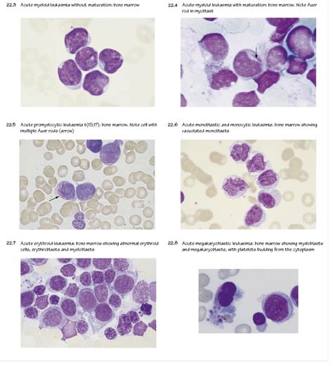Monoblast Vs Myeloblast