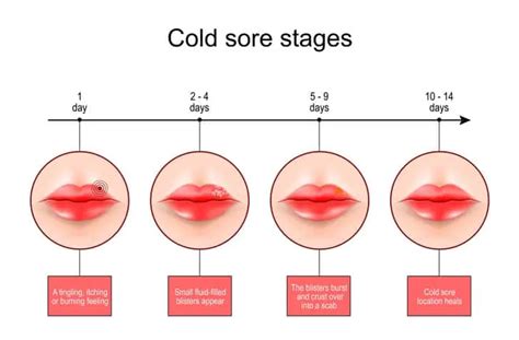What Is A Cold Sore Stasny Dental