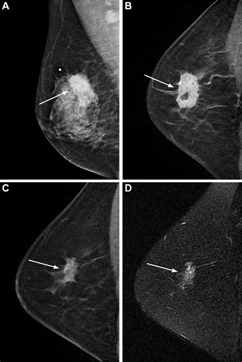Microcalcifications And Peritumoral Edema Predict Survival Outcome In