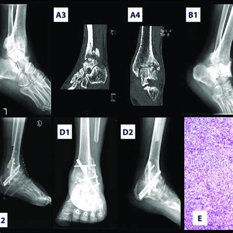A Representative Case A 50 Year Old Man With Ankle Infected Bone Download Scientific Diagram