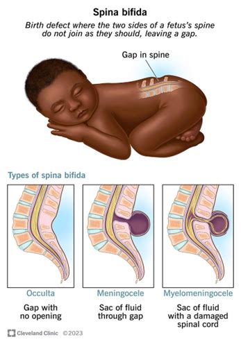 Spina Bifida Etiology Prevention And Public Health Challenges Rice
