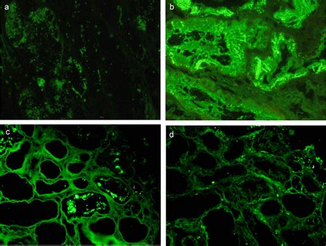 Immunofluorescence Features A Kappa Light Chain Positive Download Scientific Diagram