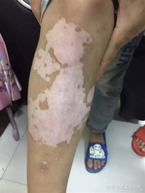 治疗白癜风，外用激素类药物能长期用吗？ 知乎