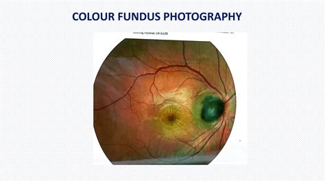 Optic Disc Melanocytoma Ppt