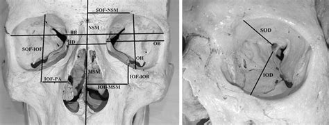 Sof Supraorbital Notch Foramen Iof Infraorbital Foramen Pa