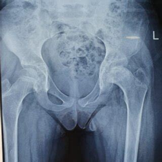 Anteroposterior Radiograph Of The Pelvis Three Months After Surgery