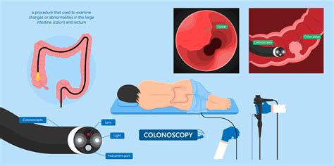 Colorectal Cancer Initial Assessment Mims Malaysia