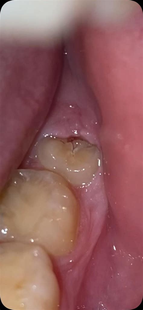 How Soon Should I See My Dentist For A Cracked Wisdom Tooth R