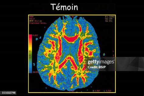 Diffusion Tensor Mri Photos And Premium High Res Pictures Getty Images