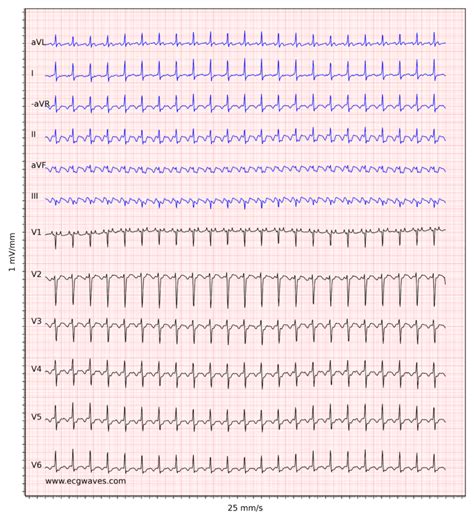 Atrial Flutter Classification Causes ECG Criteria And Management The Cardiovascular