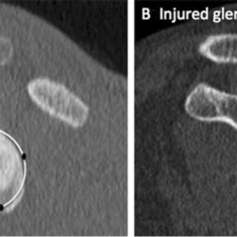 Glenoid Measurements Made Using An En Face View On T1 Weighted Mri Scan