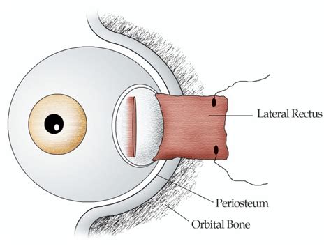Detaching The Lateral Rectus From The Sclera Download Scientific Diagram