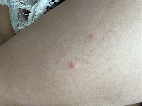 Bed Bugs Fleas Chiggers R Bugbites