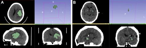 Calculation And Analysis Of The Hematoma Volumes And Hematoma Download Scientific Diagram