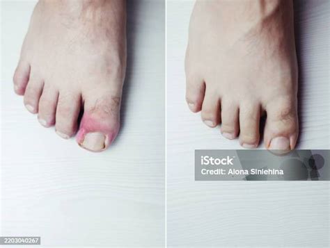 Sebelum Dan Sesudah Infeksi Jari Paronychia Onikomikosis Psoriasis Kuku Melanonikia Longitudinal
